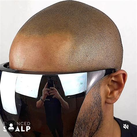 Scalp Micropigmentation Results Gallery Enhanced Scalp