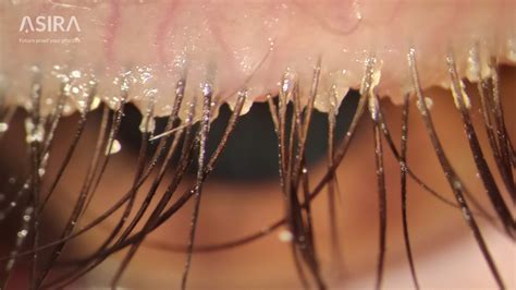 Understanding Demodex Blepharitis A Comprehensive Review