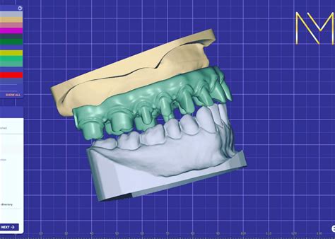 Thimble Titanium Framework On All On 6 Implant Case This Design Will