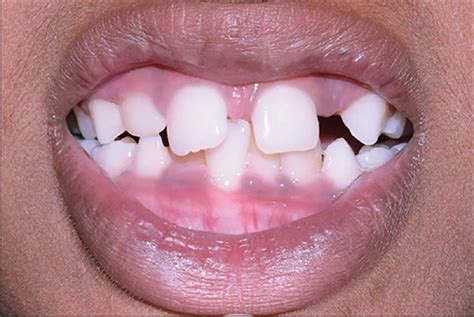 Axenfeld Rieger Syndrome Causes Symptoms Diagnosis Treatment