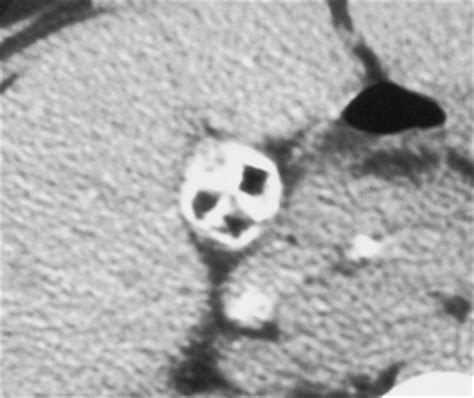 Halloween CT Cholangiogram The Medical Journal Of Australia