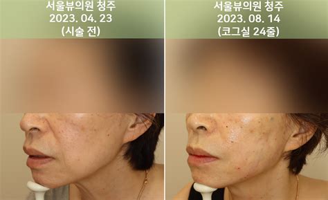 전후사진쥬베룩볼륨리프팅 서울뷰의원 청주