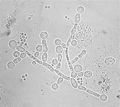 Yeast Infection Candidiasis