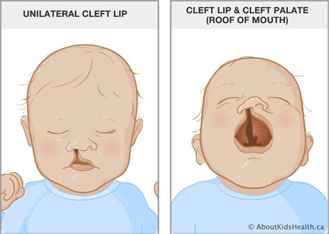 Cleft Lip And Palate Logo