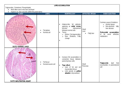 Lipid Accumulation LIPID ACCUMULATION Triglycerides Cholesterol Phospholipids Most Often