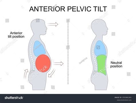 Menina Com Inclinacao Pelvica Anterior