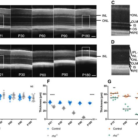Retinal Thickness In Nasal And Temporal Sides In Sd Oct Image A And