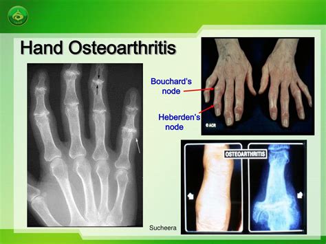 Ppt Osteoarthritis And Exercise Powerpoint Presentation Free