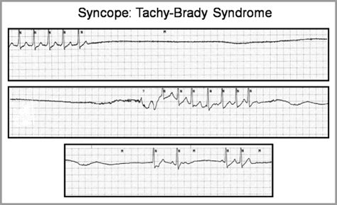 Cardiac Arrhythmias Springerlink