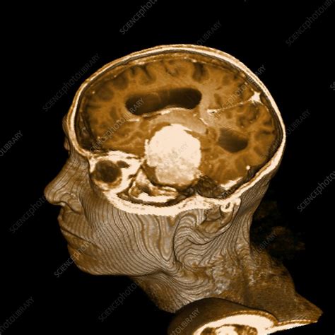 Brain Tumour Mri Scan Stock Image C006 8367 Science Photo Library
