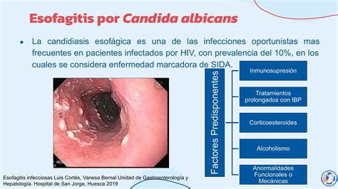 Candidiasis Esofagica Clasificacion Endoscopia
