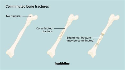 All About Comminuted Fractures