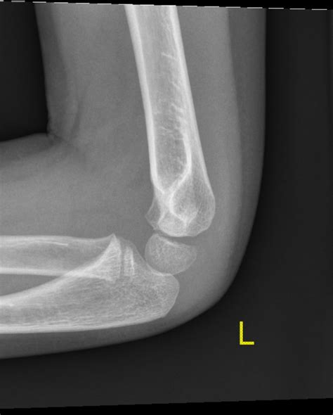 Lateral Condyle Fractures The Bone School