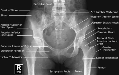 Adult Pelvis Ap View Female Pelvis Radiographic Anatomy Medical