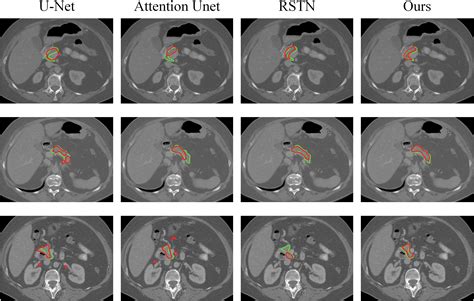 frontiers a deep learning based cascade algorithm for pancreatic