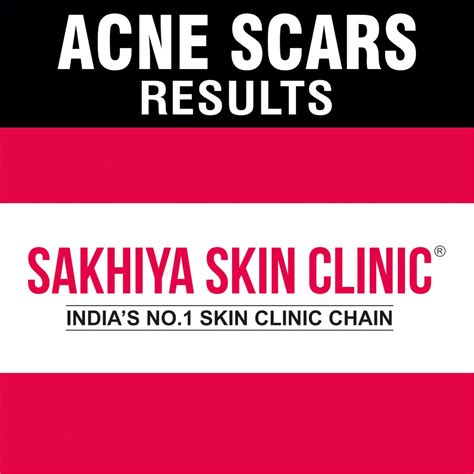 Sakhiya Skin Clinic Acne Scar Result 063992 Acne Scars Results R