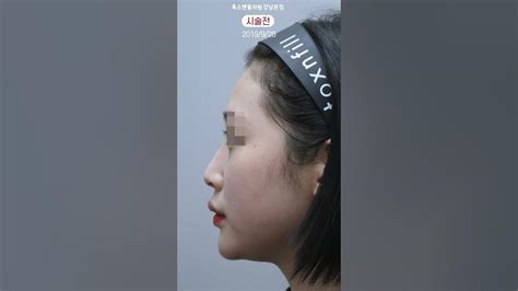 이마필러 팔자필러 앞광대필러 하면 얼굴이 이렇게 좋아진답니다~ Youtube