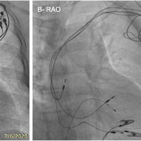 Pdf Inhibition Of Ventricular Output In A Dual Chamber Pacemaker With