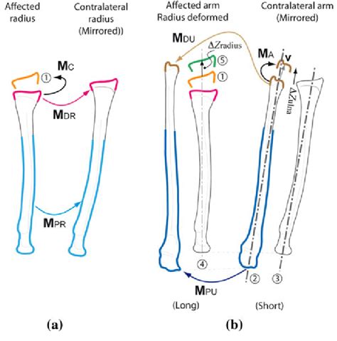 A Method For Bringing The Distal Radius Segment In The Planned Position