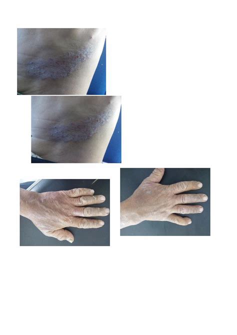 Docx Tinea Corporis Dan Da Dokumen Tips