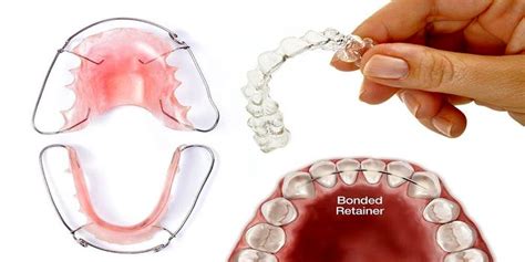 The Different Types Of Retainers OdontoVida