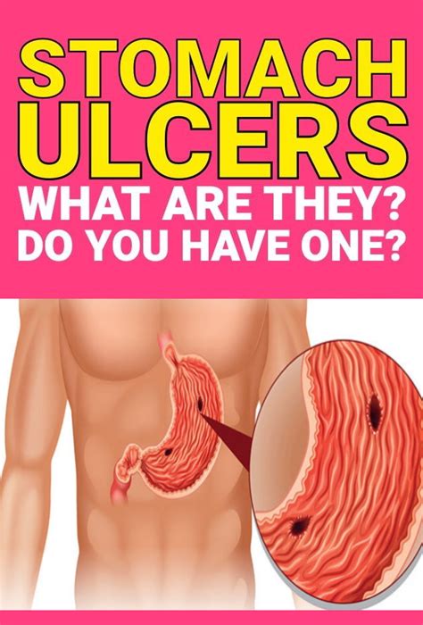 Stomach Ulcers And What You Can Do About Them Healthy Lifestyle