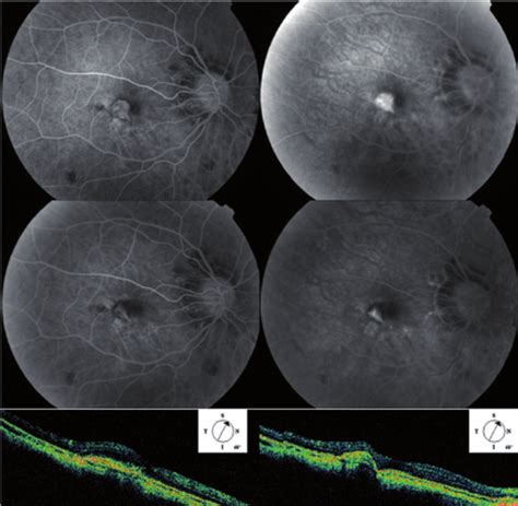 Intravitreal Bevacizumab Treatment For Choroidal Neovascularization In Download Scientific