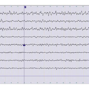 EEG Showing Asymmetric Background Activity With The Left Frontotemporal Download Scientific