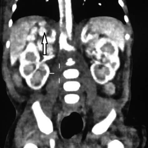 Abdominal Radiography Revealed A Central Gastric Bubble With The Download Scientific Diagram