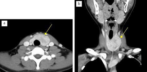 Contrast Enhanced Computed Tomography A B A Nodular Lesion Download Scientific Diagram