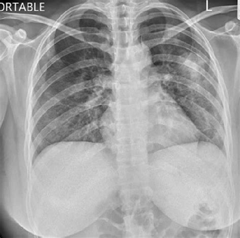 Frontal Ap Cxr Shows An Increase Of Patchy Opacities With Ground Glass