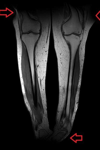 Gradient Non Linearity Artifact Image Distortion Artifact