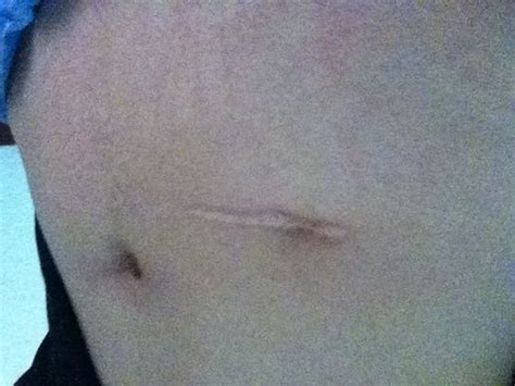 Laparoscopic Appendectomy Scars