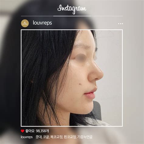 루브르성형외과 처음처럼 자연스럽게 전후사진후기셀카후기
