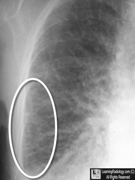 Kerley B Lines Pulmonary Edema Picture This You Are Shown A Xray Of A
