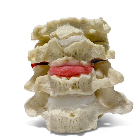 Cervical Instability Dynamic Disc Model C4 7