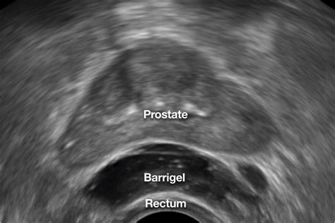 Rectal Spacer Improves Prostate Radiation Side Effects Northside Hospital