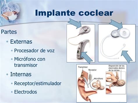 Partes De Um Diagrama De Implante Coclear
