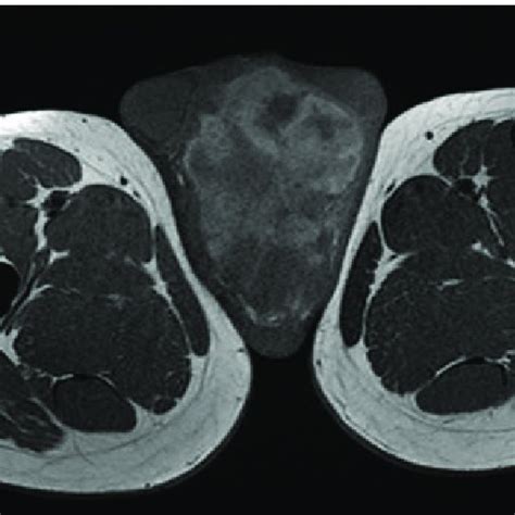 Mri T1 Axial Section Download Scientific Diagram