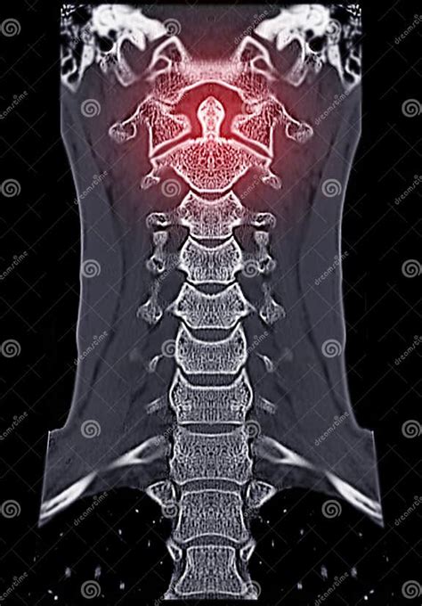 Ct C Spine Or Cervical Spine 3d Rendering Image And Sagittal Stock
