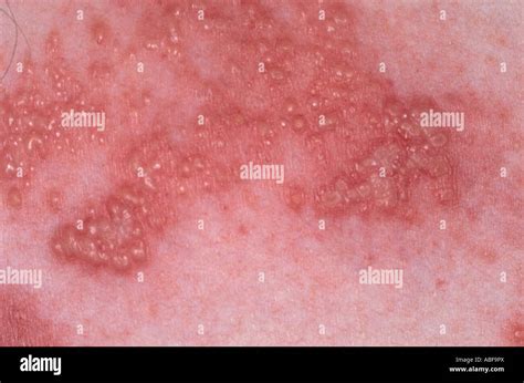 What Are Skin Vesicles At Carol Bandy Blog