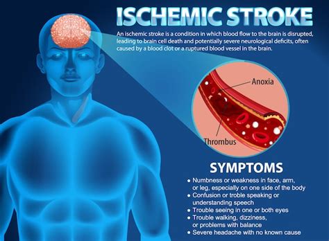 Premium Vector Informative Poster Of Ischemic Stroke