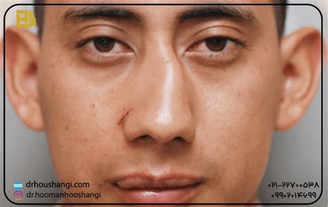 شکستگی صورت درمان، علائم و عوارض شکستگی صورت چیست