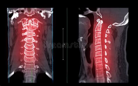 Ct Scan Of Cervical Spine C Spine Stock Illustration Illustration Of Case Head 250522500