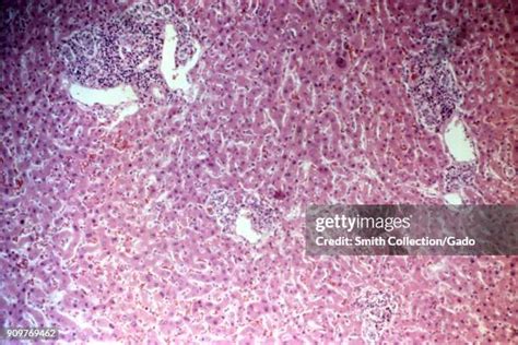 Cholangitis Photos And Premium High Res Pictures Getty Images