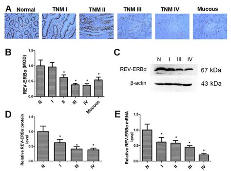 rev‑erbα reduction is associated with clinicopathological features and prognosis in human