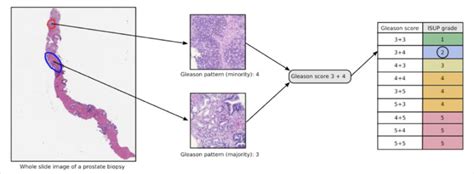 An Illustration Of The Gleason Grading Process For An Example Biopsy Download Scientific