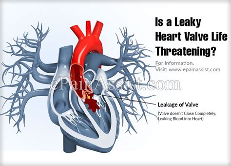Is A Leaky Heart Valve Life Threatening
