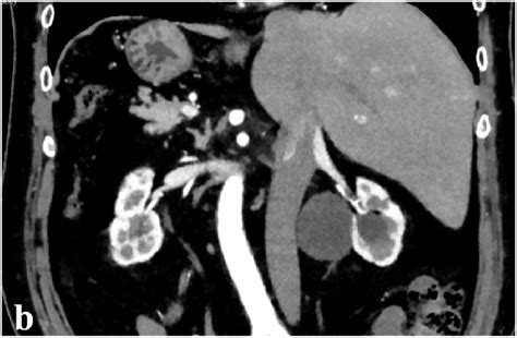 B Ct Findings With 46mm Exophytic Renal Mass At The Left Renal Hilum