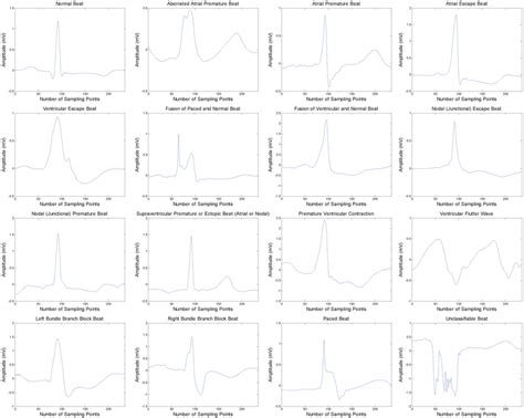 Illustration Of 16 Types Of Electrocardiogram Ecg Beats Download